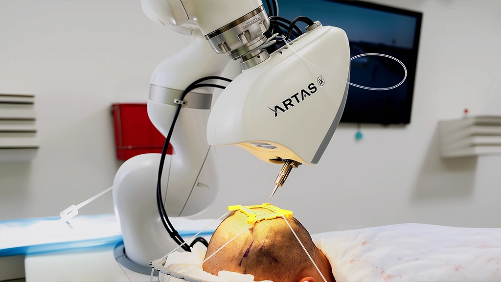 What is Robotic Hair Transplant? Is It Better Than Manual?