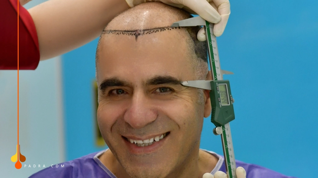 Temple Hair Transplant – Redefine Your Hair at Lower Cost